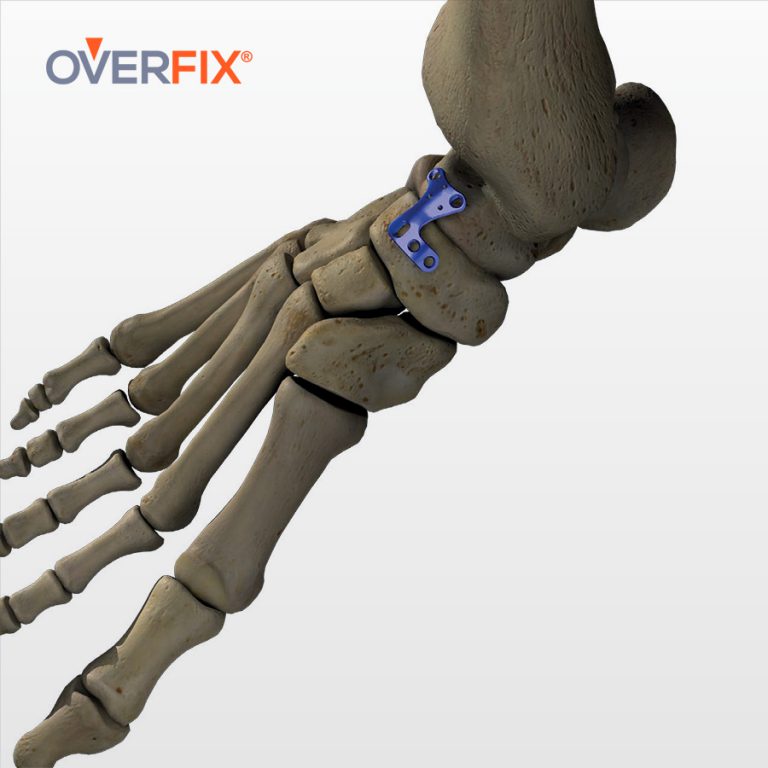Pie y tobillo archivos - Bioadvance