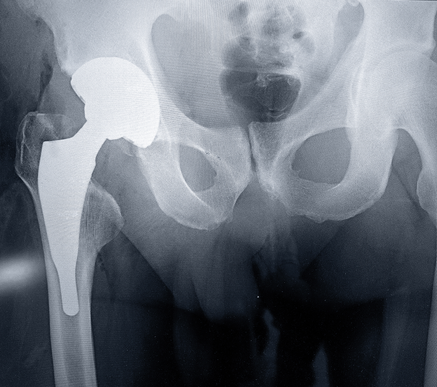 Artroplastia Total de Cadera Derecha - Bioadvance